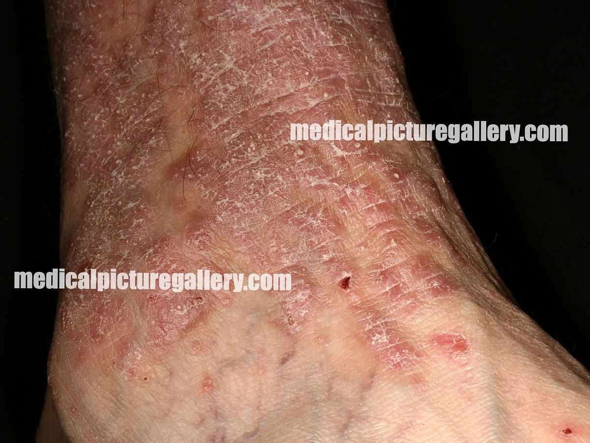 Lichen hypertrophicus